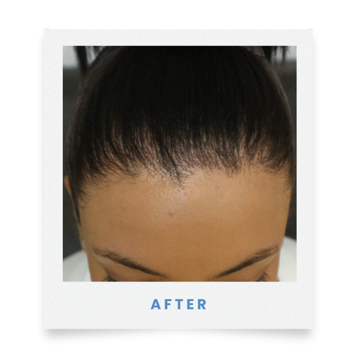 Forehead Reduction Surgery - Medical Hair Restoration