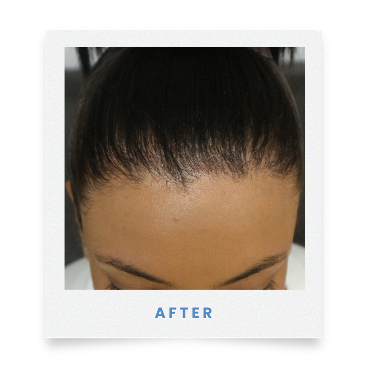 Forehead Reduction Surgery - Medical Hair Restoration