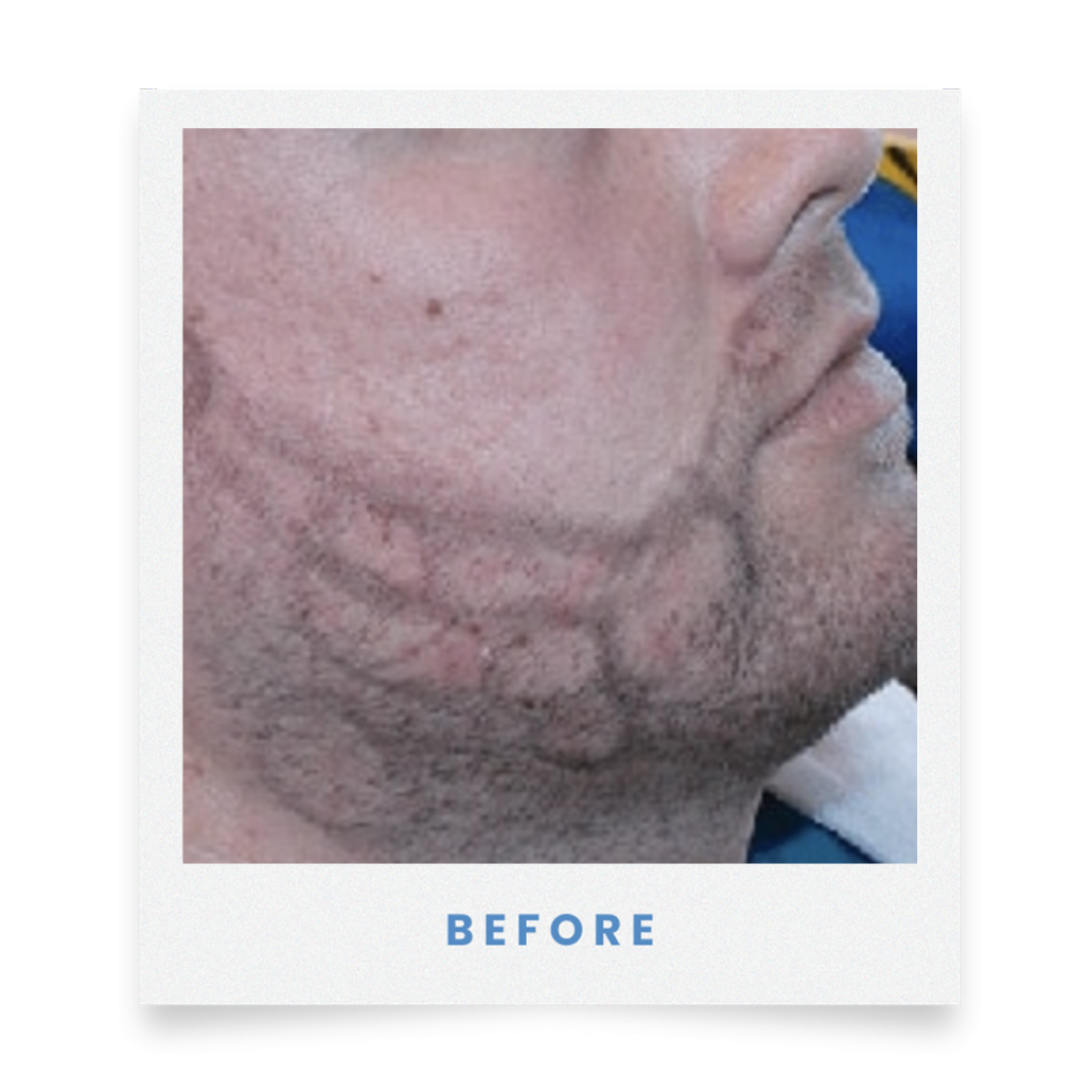 Beard Transplant - Medical Hair Restoration