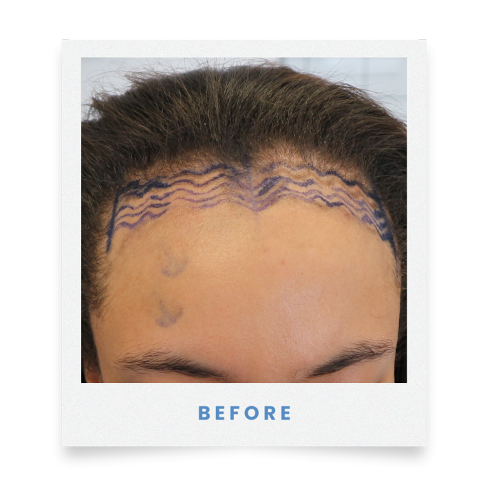 Forehead Reduction Surgery - Medical Hair Restoration