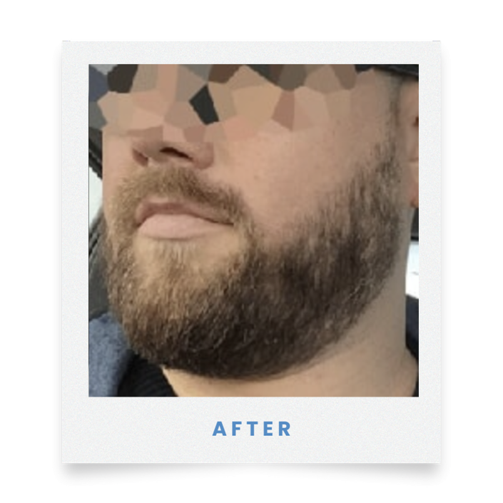 Beard Transplant - Medical Hair Restoration